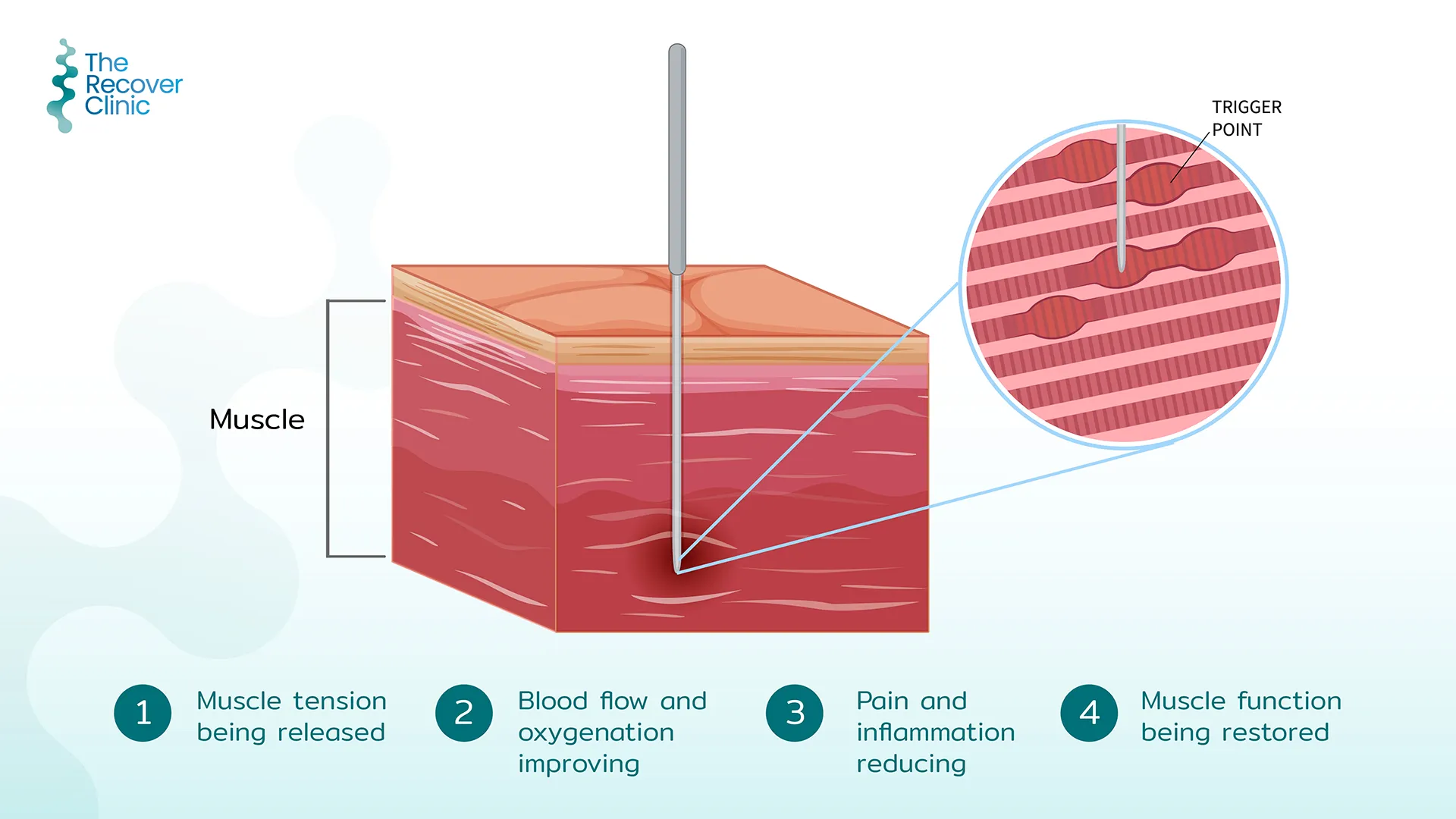 ฝังเข็มตะวันตก คลายปวดกล้ามเนื้อเรื้อรังและออฟฟิศซินโดรม